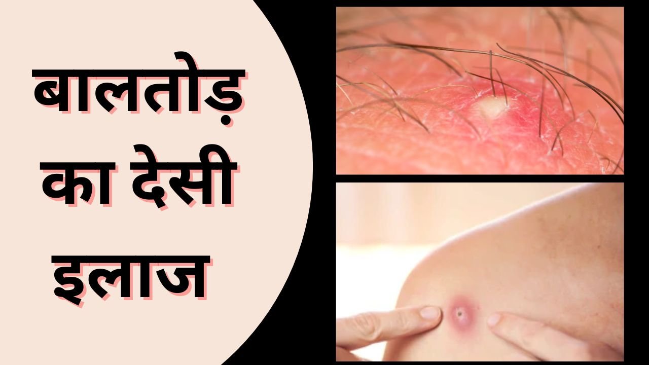 Baltod hone par kya kare blisters folliculitis boils home remedies ...